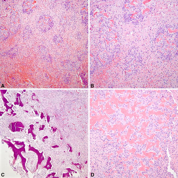Epithelioid Multinodular Osteoblastoma of the Mandible: A Case Report ...