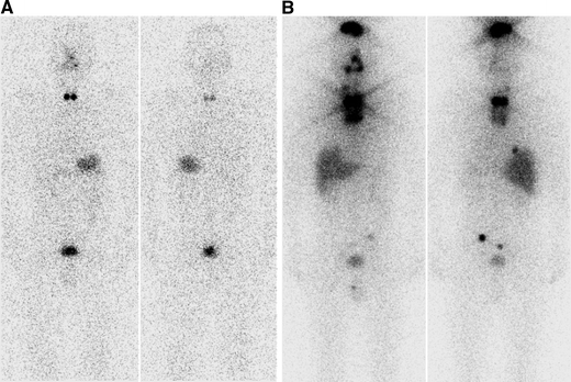 Comparisons of I-123 diagnostic and I-131 post-treatment scans for ...