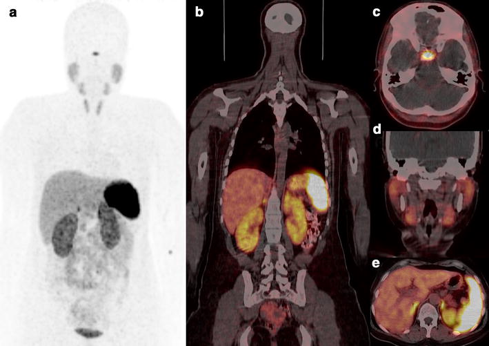 Physiological and tumoral uptake of 68Ga-DOTATATE: standardized uptake ...