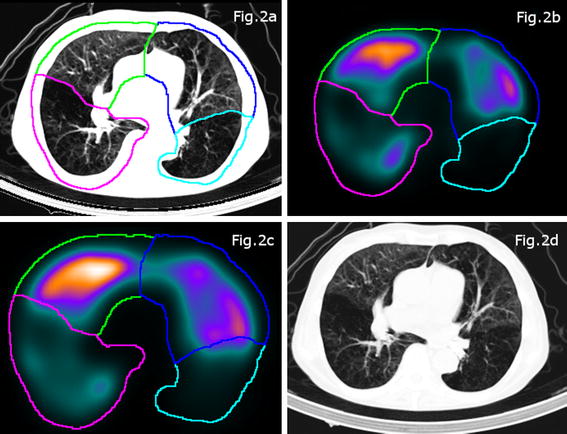 Ventilation/perfusion SPECT or SPECT/CT for lung function imaging in ...