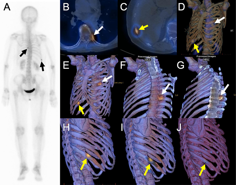 3d Spect Ct Fusion Using Image Data Projection Of Bone Spect Onto 3d