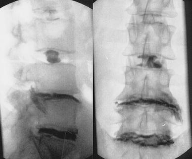 Discography in practice: a clinical and historical review | SpringerLink