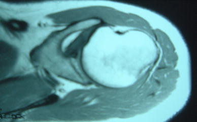 Coracoid impingement syndrome: a literature review | SpringerLink