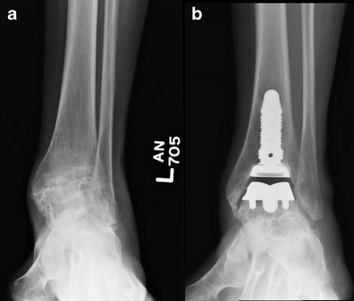 Total ankle arthroplasty in end-stage ankle arthritis | SpringerLink