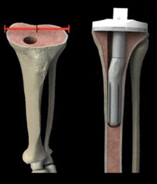 The role of offset stems in revision knee arthroplasty | SpringerLink