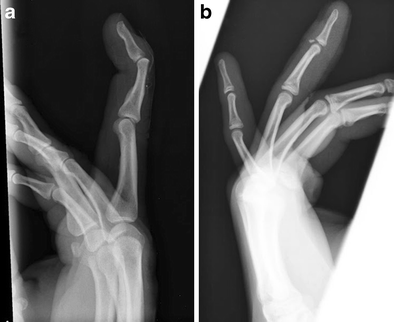 A review of mallet finger and jersey finger injuries in the athlete ...