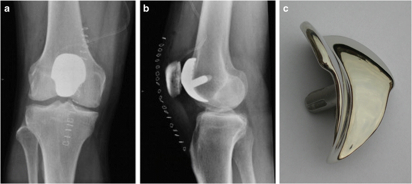 Advances in Patellofemoral Arthroplasty | SpringerLink