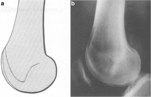 Trochleoplasty: Indications and Technique | SpringerLink