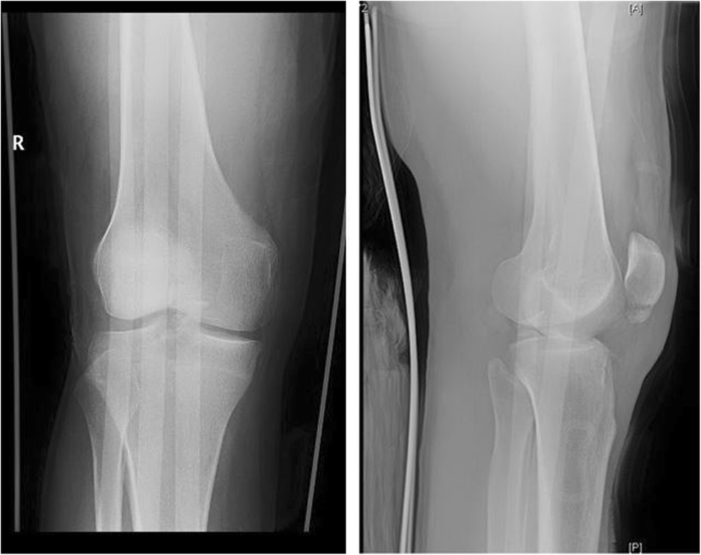 Posterior Cruciate Ligament Avulsion Fractures | SpringerLink