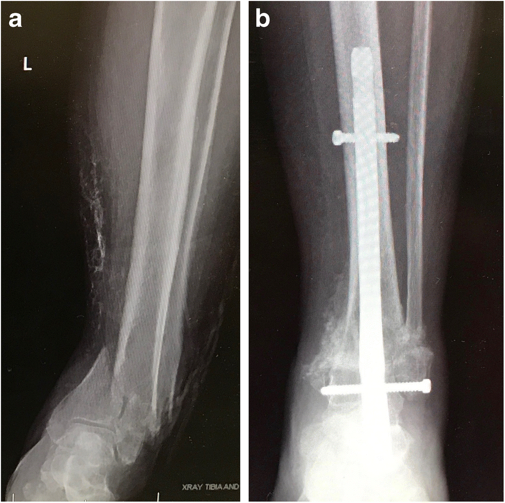 Retrograde Hindfoot Nailing for Acute Trauma | SpringerLink