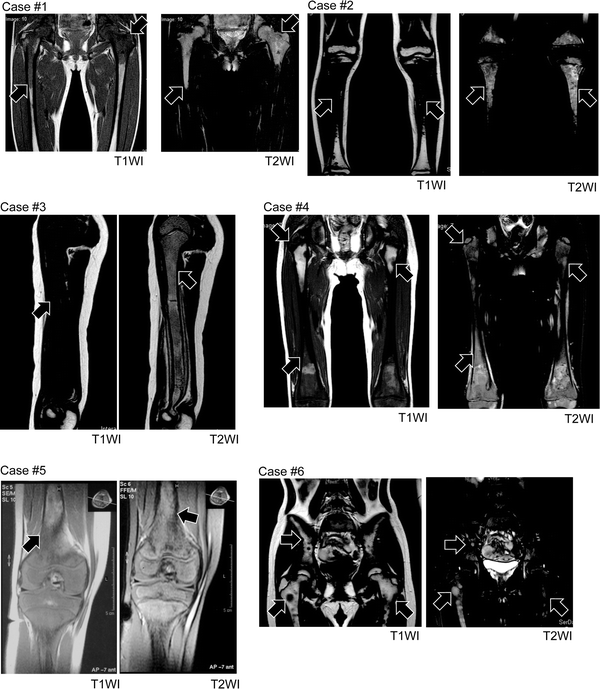 Case series of pediatric acute leukemia without a peripheral blood ...