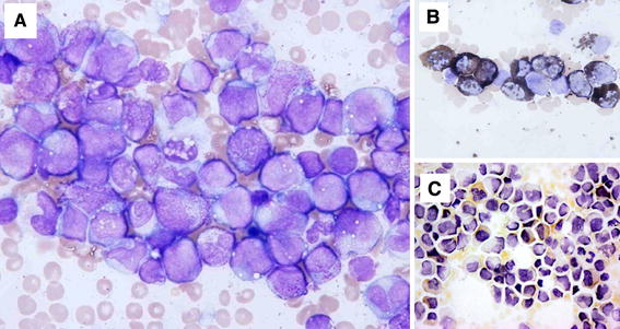 Coexistence of inversion 16 and the Philadelphia chromosome comprising ...