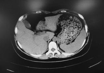 Laparoscopic splenectomy for immune thrombocytopenia (ITP) patients ...