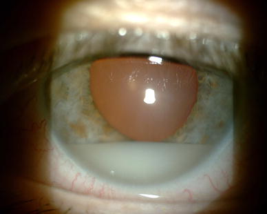 Hypopyon as the first sign of relapse in acute lymphoblastic leukaemia ...