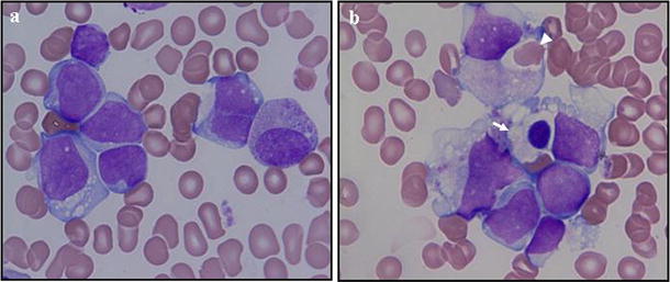 RUNX1 mutation associated with clonal evolution in relapsed pediatric acute myeloid leukemia ...