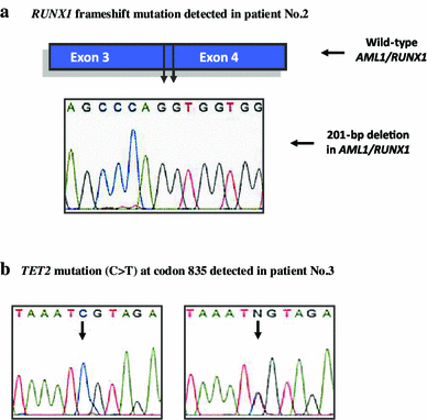 RUNX1 mutation associated with clonal evolution in relapsed pediatric acute myeloid leukemia ...