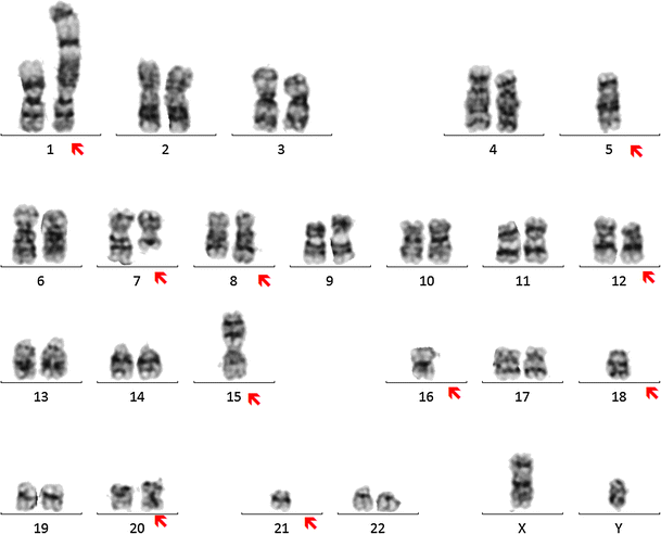 Complex hypodiploid acute myeloid leukaemia secondary to chemotherapy ...