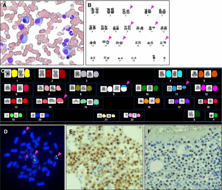 PAX5-positive plasma cell myeloma with t(9;14;11)(p13;q32;q13), a novel ...