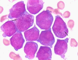 Transient ischemic attack as an unusual initial manifestation of acute ...