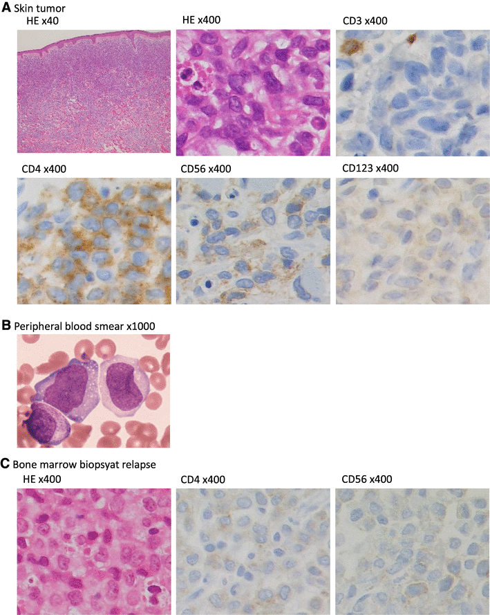 Blastic plasmacytoid dendritic cell neoplasm arising from clonal ...