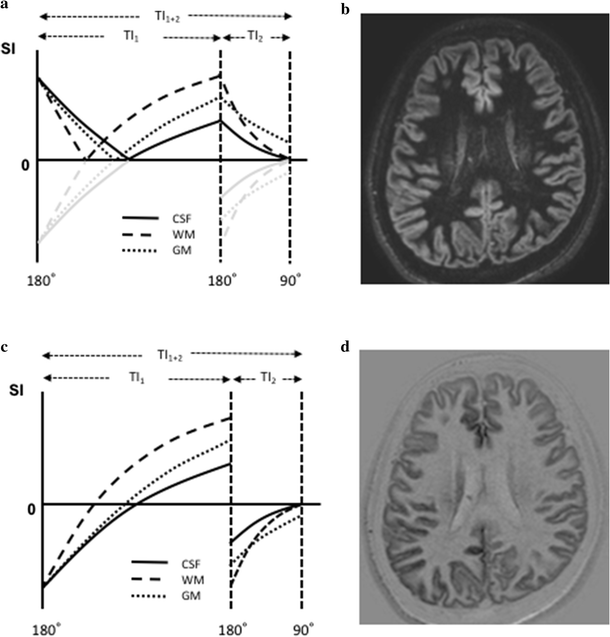 Double inversion recovery imaging of the brain: deriving the most ...