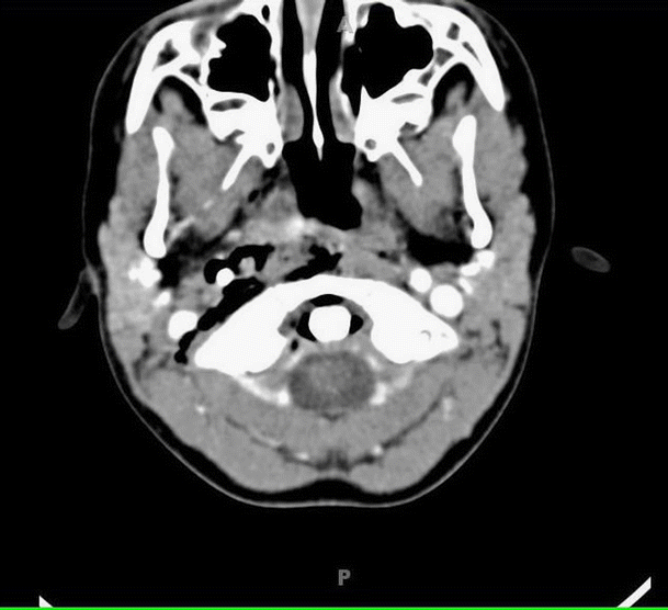 High-pressure water injection injury | SpringerLink