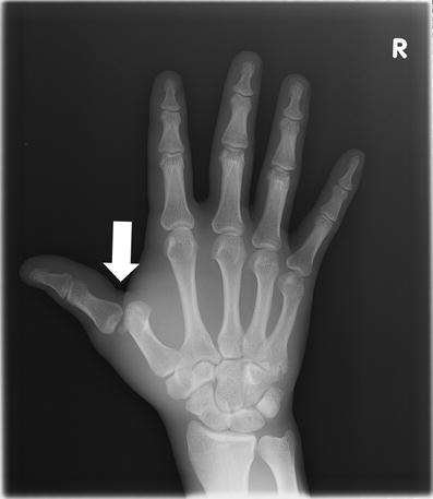 Complex metacarpophalangeal dislocation | SpringerLink