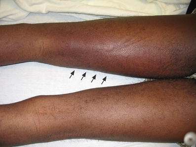 Primary pyomyositis caused by ca-MRSA | SpringerLink