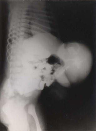 Heteropagus Twins—A Tale of Two Cases | SpringerLink