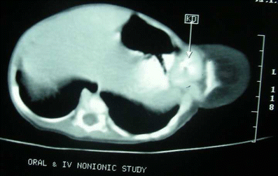 Heteropagus Twins—A Tale of Two Cases | SpringerLink