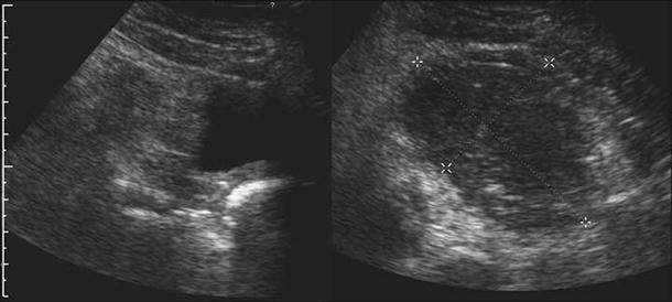 Phlegmonous Appendicitis and Mobile Cecum Syndrome Simulating Ileal ...