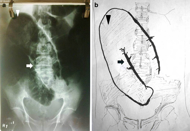 Ileosigmoid Knot | SpringerLink
