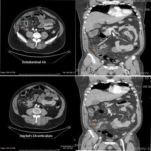 Perforated Meckel’s Diverticulum | SpringerLink