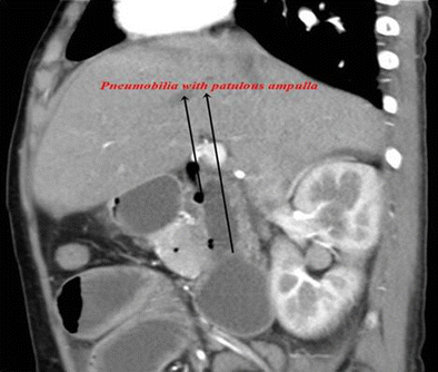 Laparoscopic Management of a Proximal Jejunal Gallstone Ileus with ...