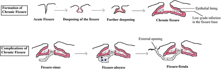 Oral Plus Local Antibiotics Significantly Reduce the Need for Operative ...