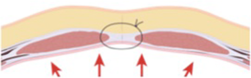 Editorial: Ten Commandments of Safe and Optimum Abdominal Wall Closure ...