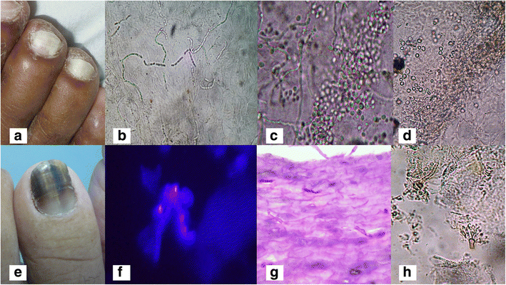 Onychomycosis Laboratory Diagnosis: Review | SpringerLink
