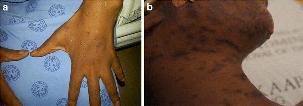 Emergomyces: a New Genus of Dimorphic Fungal Pathogens Causing ...