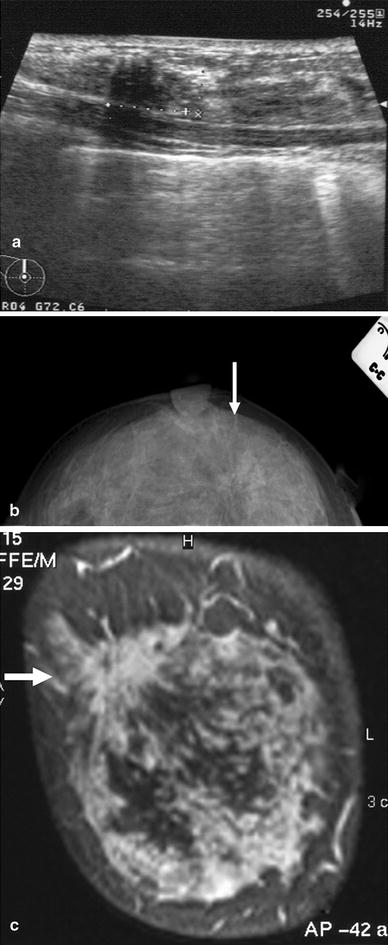 Six cases showing radial scar/complex sclerosing lesions of the breast ...