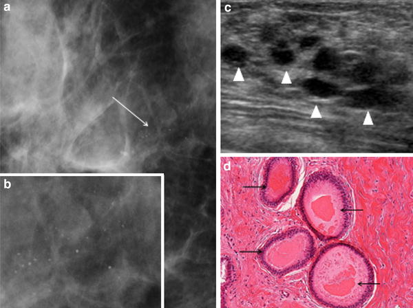 Which patients require or can skip biopsy for breast clustered ...