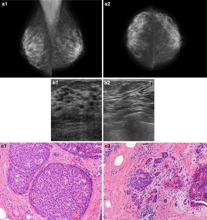 Which patients require or can skip biopsy for breast clustered ...