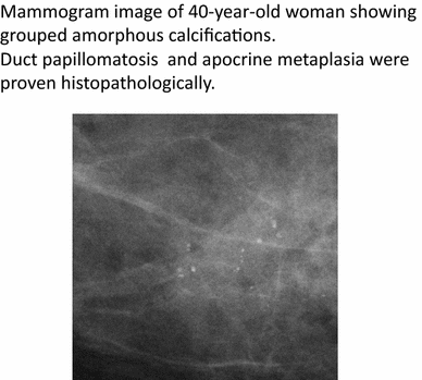 Overcalling low-risk findings: grouped amorphous calcifications found ...