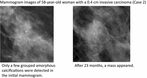 Overcalling low-risk findings: grouped amorphous calcifications found ...
