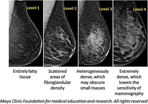 An overview of mammographic density and its association with breast ...
