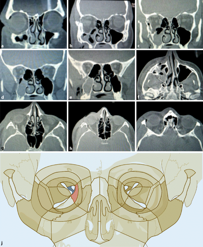 Orbitafrakturen nach der AO﻿-﻿CMF-Level-3-Trauma-Klassifikation ...