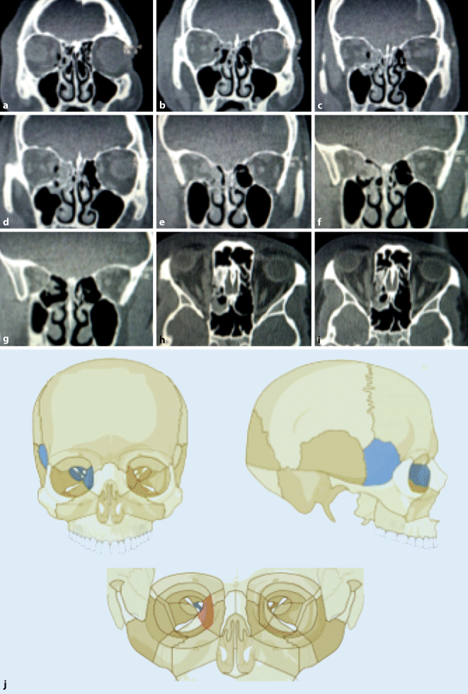 Orbitafrakturen nach der AO﻿-﻿CMF-Level-3-Trauma-Klassifikation ...