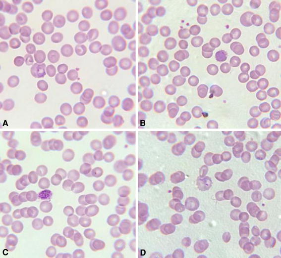 Exflagellated Microgametes of Plasmodium Vivax in Human Peripheral ...