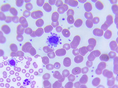 Lymphocytic Platelet Satellitism | SpringerLink