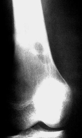 Non-ossifying fibroma, fibrous cortical defect and Jaffe–Campanacci ...