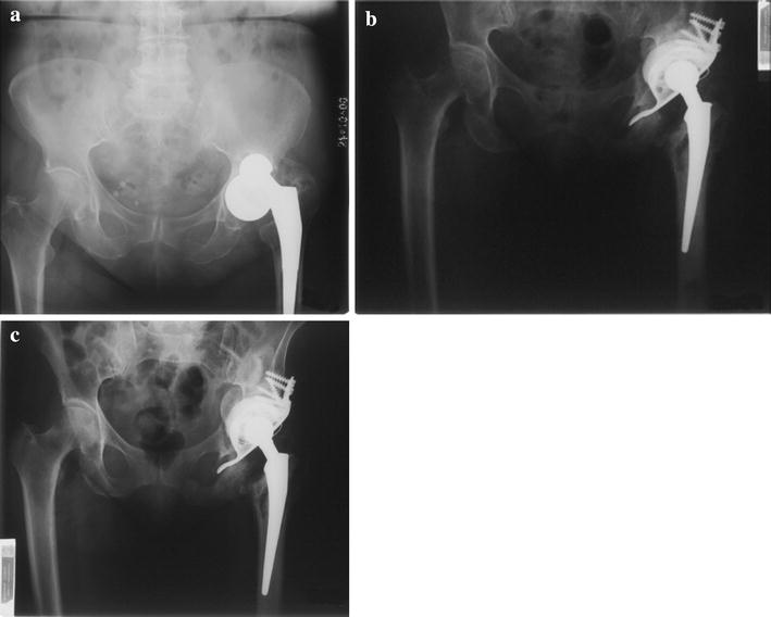 Total hip arthroplasty revision in elderly people with cement and Burch ...